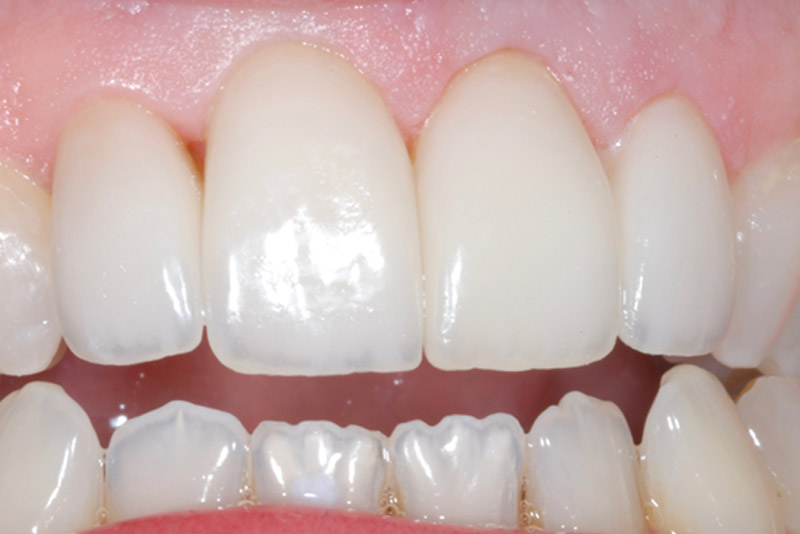 Veneers l Dental Veneers & Bonding Sandyford Dublin