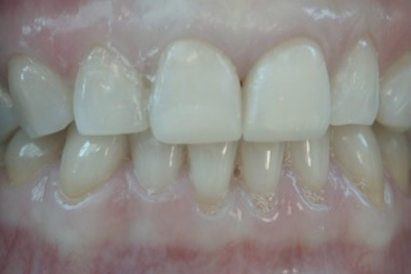 Dental Bonding Dublin 18 l Chipped Tooth Repair