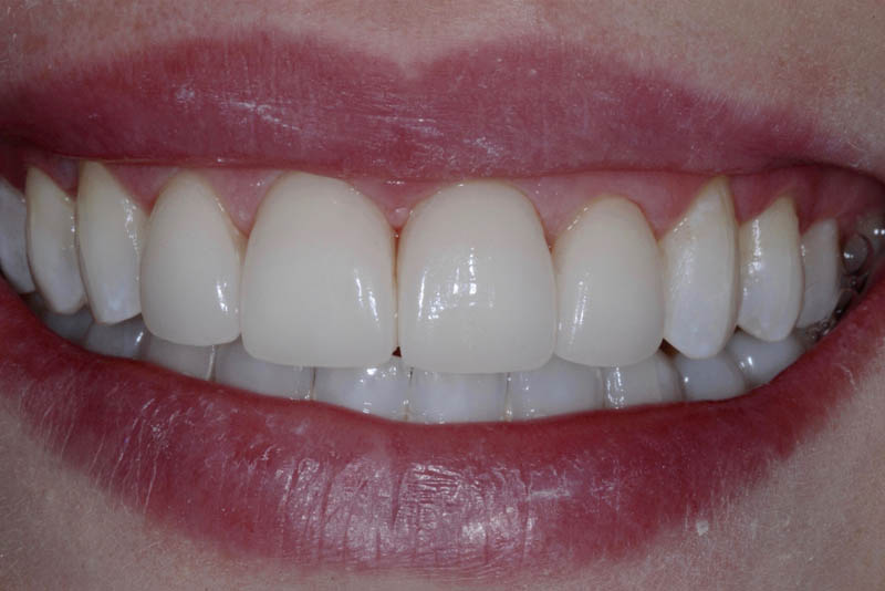 Veneers l Dental Veneers & Bonding Sandyford Dublin