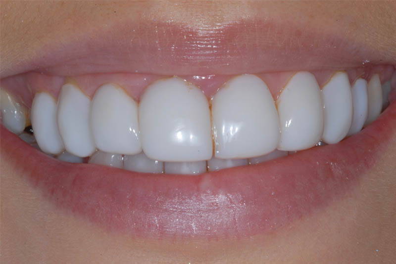 Veneers l Dental Veneers & Bonding Sandyford Dublin