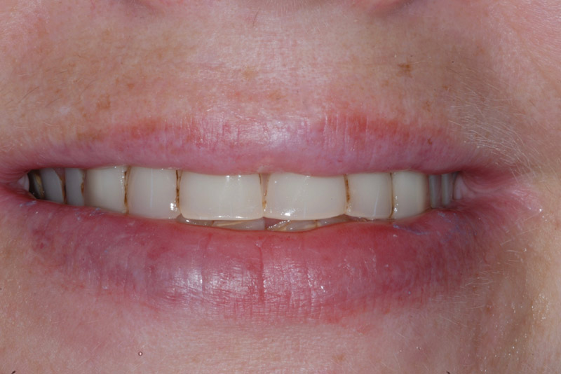 Digital Dentures l Digital Dentures and Implants Dublin