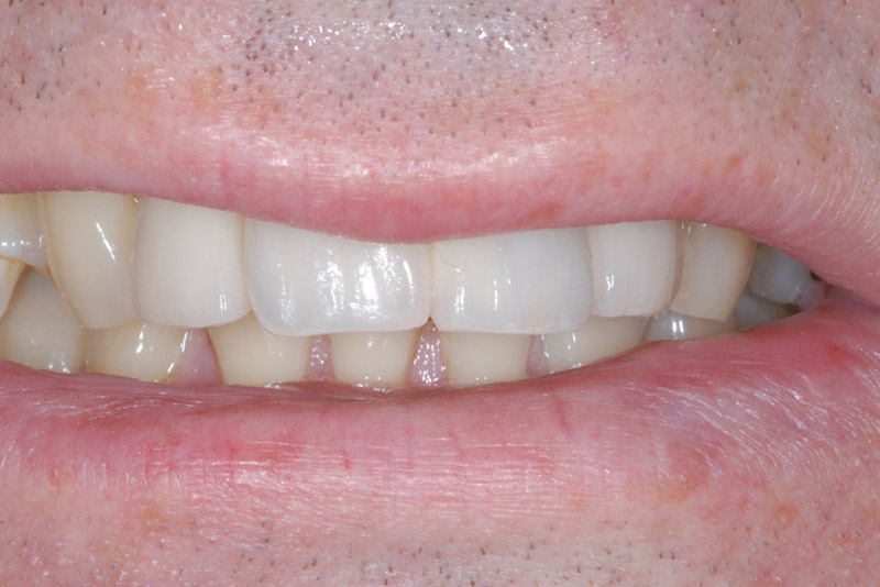 Dental Crowns l Tooth Bridges l Dentist in Sandyford