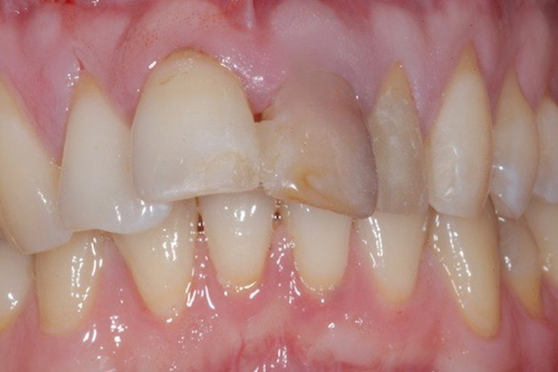 Dental Crowns l Tooth Bridges l Dentist in Sandyford