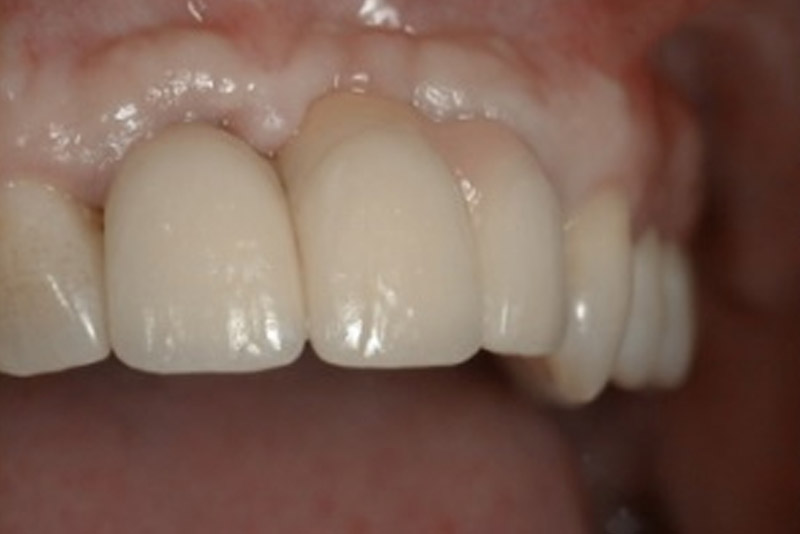 Implants Dublin l Dental Implants Dublin l Dental Implants