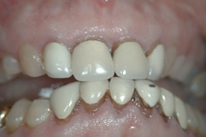 Management & Restoration of Complex or Failing Dentition