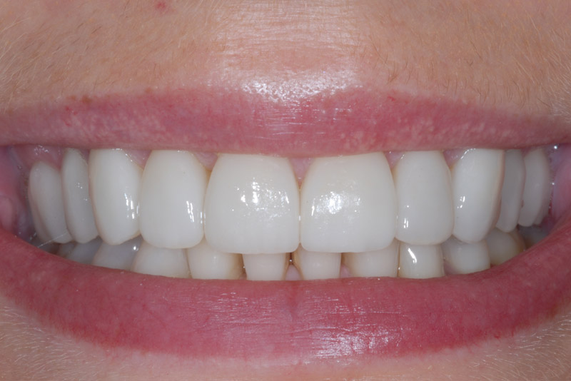 Veneers l Dental Veneers & Bonding Sandyford Dublin
