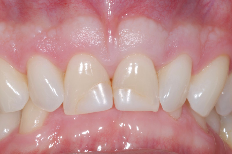 Veneers l Dental Veneers & Bonding Sandyford Dublin