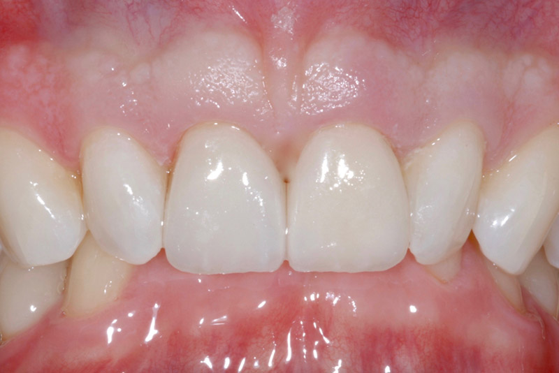 Veneers l Dental Veneers & Bonding Sandyford Dublin