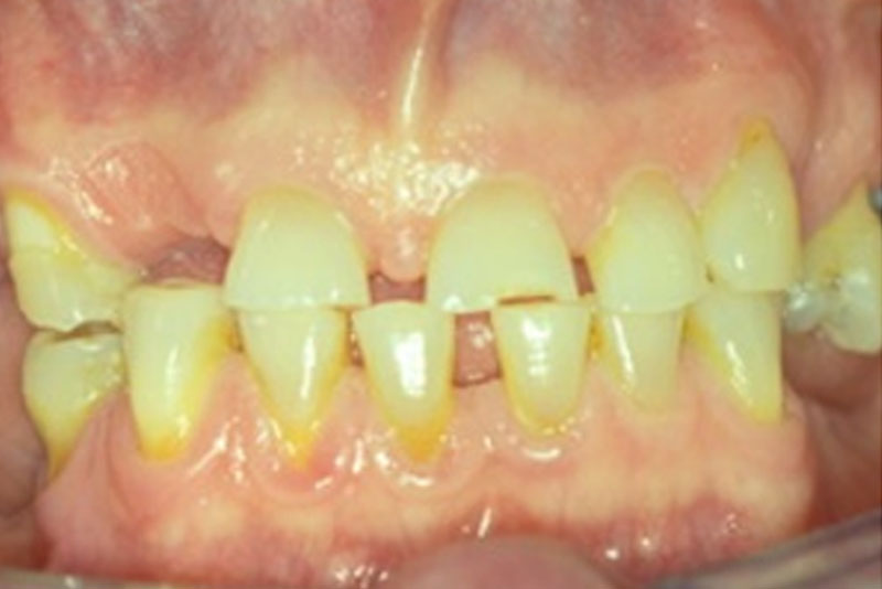 Management & Restoration of Complex or Failing Dentition