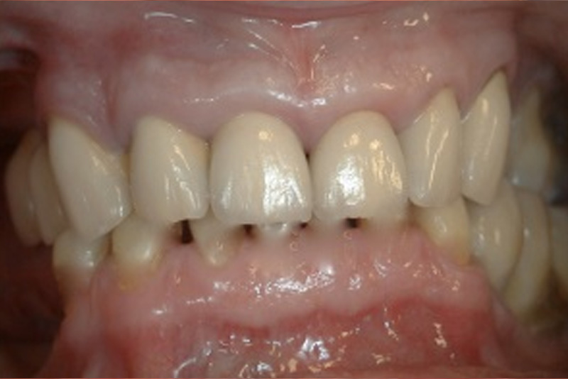 Bruxism, Erosion, Severe Wear l Teeth Grinding Repairs Dublin