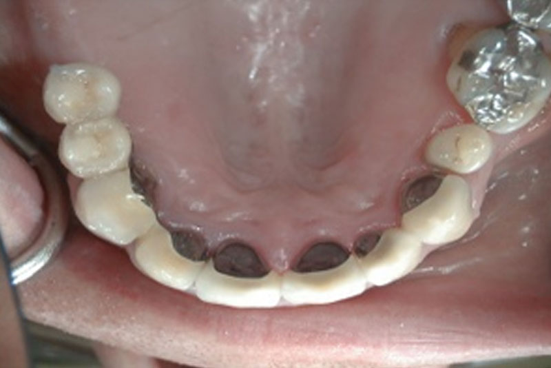 Bruxism, Erosion, Severe Wear l Teeth Grinding Repairs Dublin