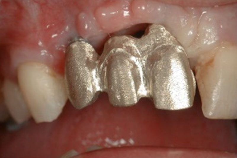 Complex Implant Supported Restorations l Dental Implants Dublin