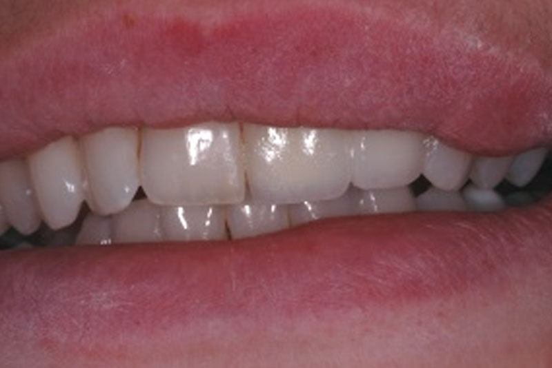 Complex Implant Supported Restorations l Dental Implants Dublin