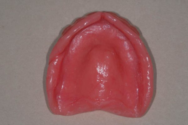 Complex Denture Treatments Dublin 18 l Dentures Dublin