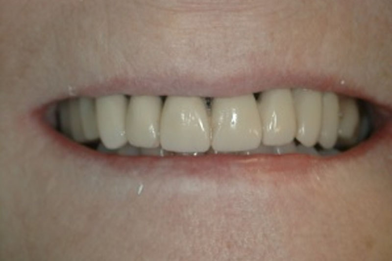 Removable Partial Denture Services l Partial Dentures Dublin