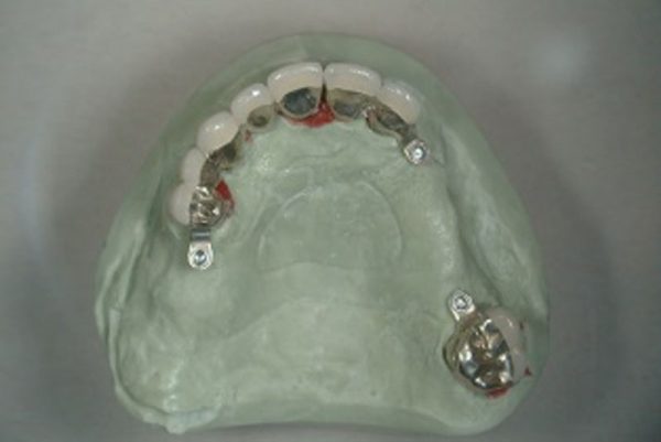 Removable Partial Denture Services l Partial Dentures Dublin