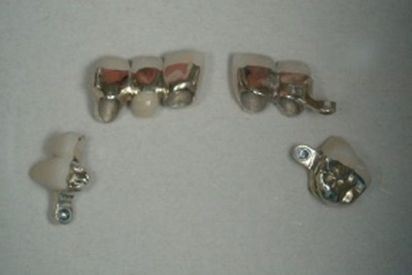 Removable Partial Denture Services l Partial Dentures Dublin