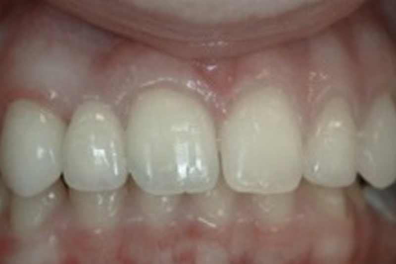 Prosthodontics Explained l Prosthodontist Dublin